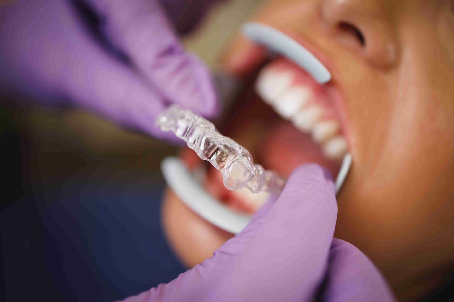 Invisalign Vs Braces Which Is More Comfortable And Convenient invisalign-vs-braces-which-is-more-comfortable-and-convenient